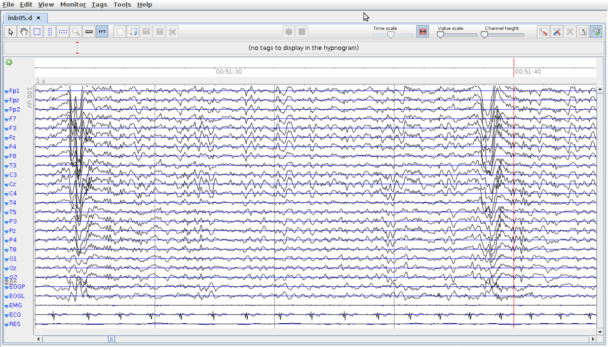 Pracownia EEG/EEG spoczynkowe – Brain-wiki
