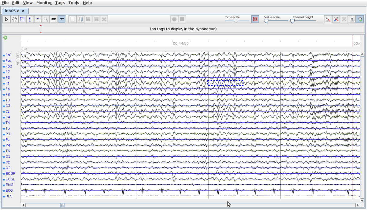 Pracownia EEG/EEG spoczynkowe – Brain-wiki