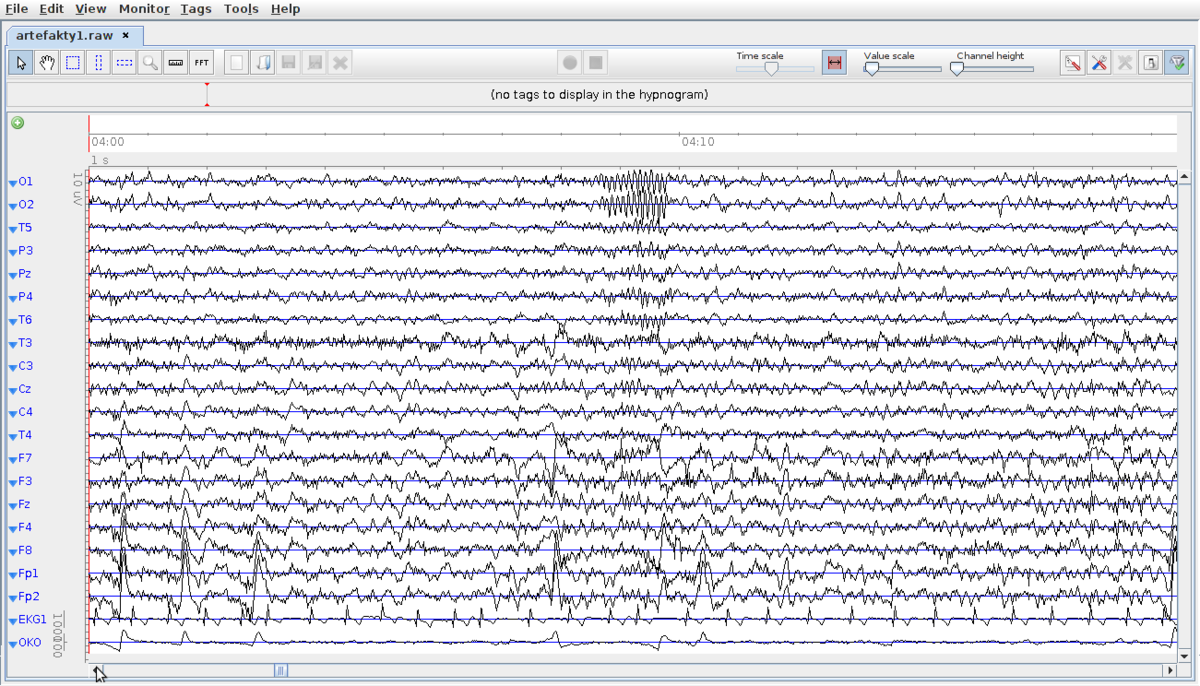 Pracownia EEG/EEG spoczynkowe – Brain-wiki