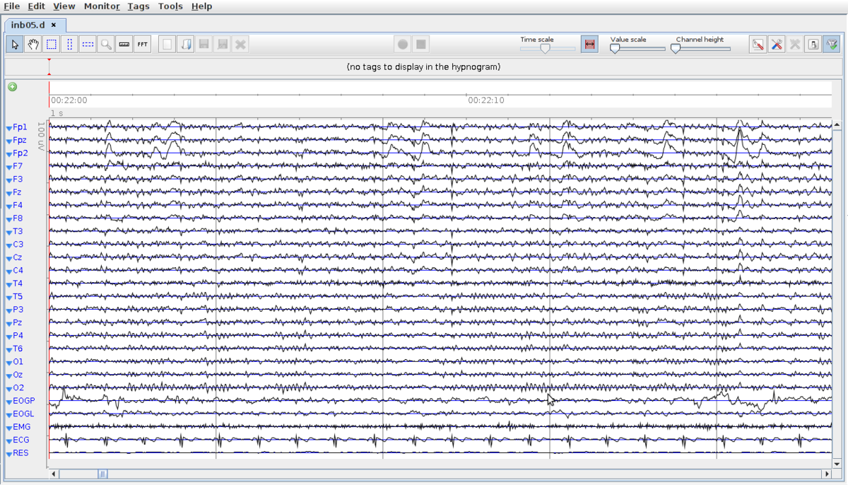 Pracownia EEG/EEG spoczynkowe – Brain-wiki
